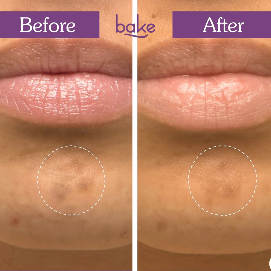 Spot Erase Micro point Hydrocolloid Patches for Dark Spots, Post Acne ...